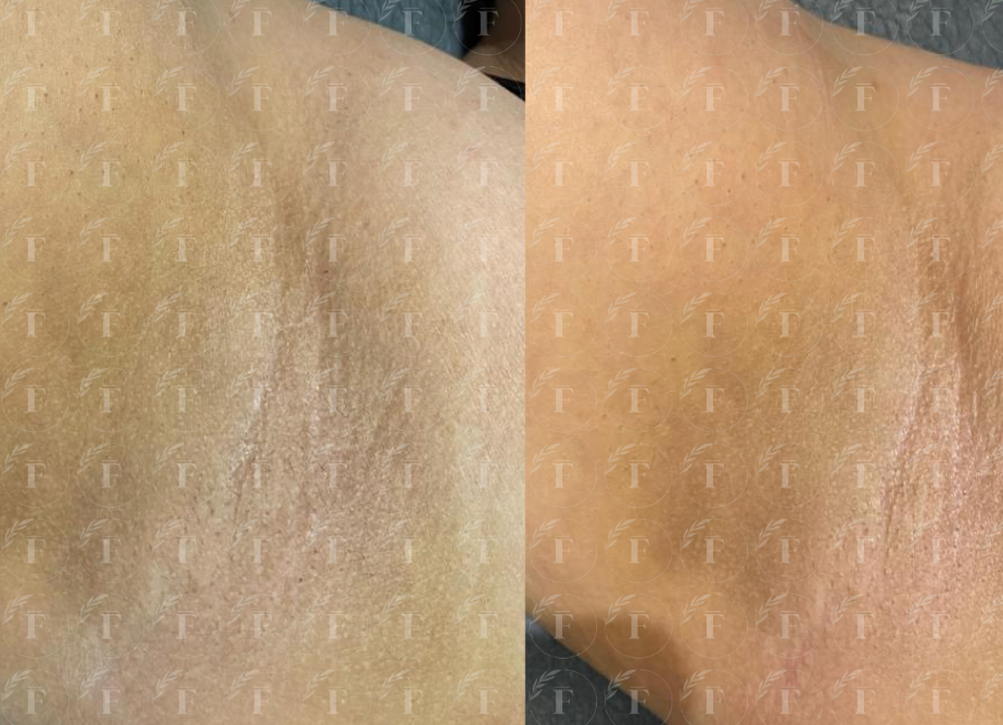 Logra Axilas Perfectas con Nuestro Blanqueamiento de Axilas